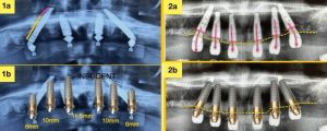 Shortcomings of NEODENT’s® GM Implants – Paragon Implant