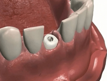 Shortcomings of Nobel Biocare’s® N1™ System – Paragon Implant