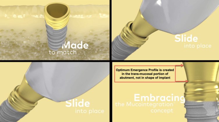 Shortcomings of Nobel Biocare’s® N1™ System – Paragon Implant