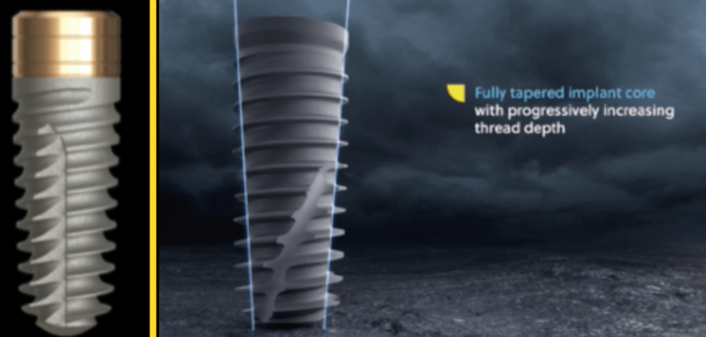 Shortcomings of ZimVie’s Tapered Screw-Vent with Trabecular Metal ...