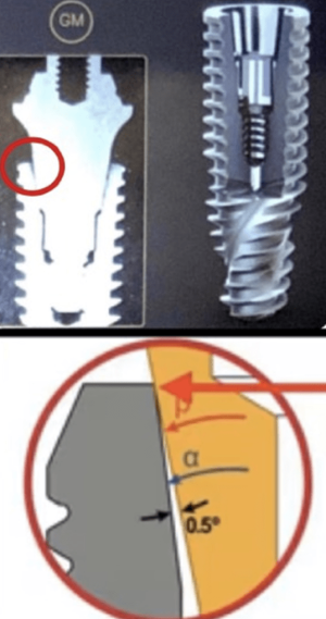Shortcomings of NEODENT’s® GM Implants – Paragon Implant