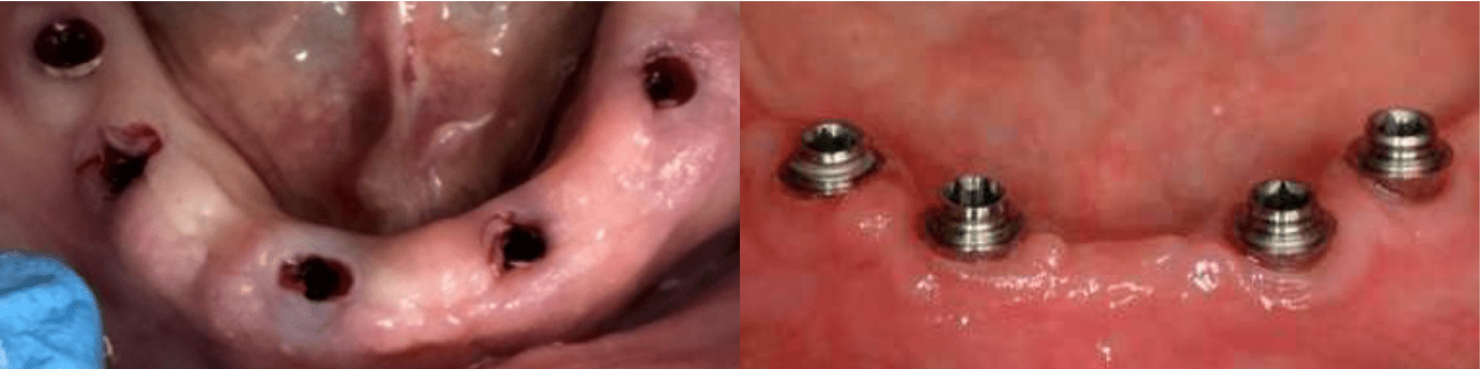 Shortcomings of TRI-Dental’s® Matrix Implant – Paragon Implant