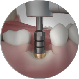 GEN5™ – Paragon Implant