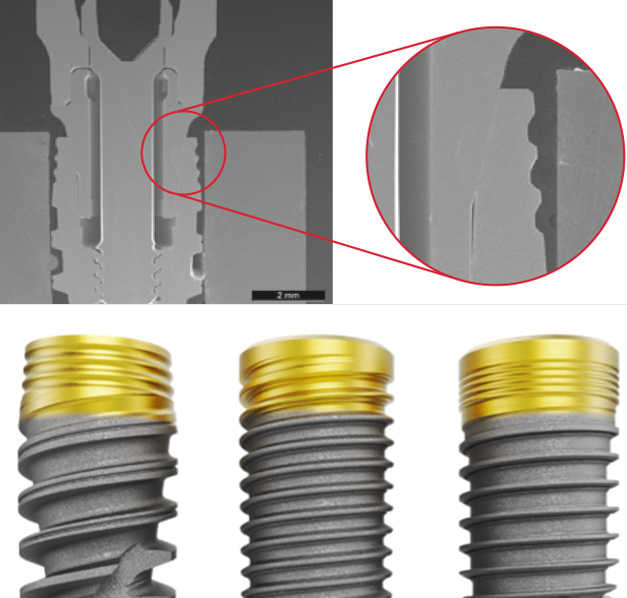Shortcomings of NobelActive™ Implant in Contrast to Paragon’s TriActive ...