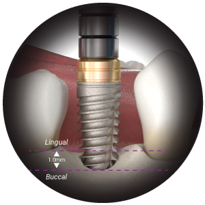 GEN5™ – Paragon Implant